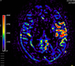 造影剤を使わない灌流MRI画像（ASL; arterial spin labeling） ｜ 公益財団法人 甲南会 甲南医療センター（旧）甲南病院